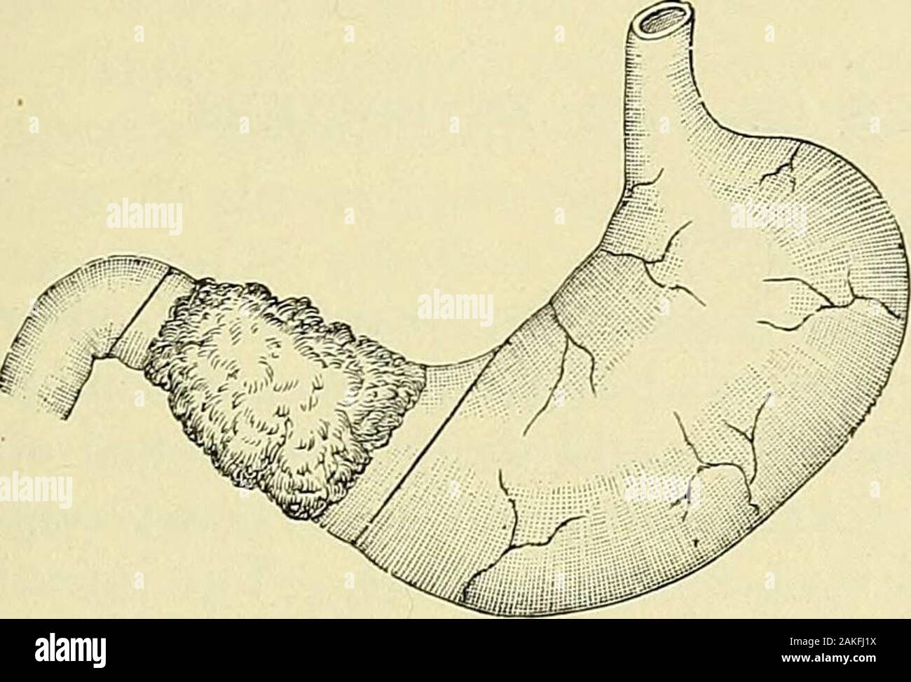 Total gastrectomy hi-res stock photography and images - Alamy