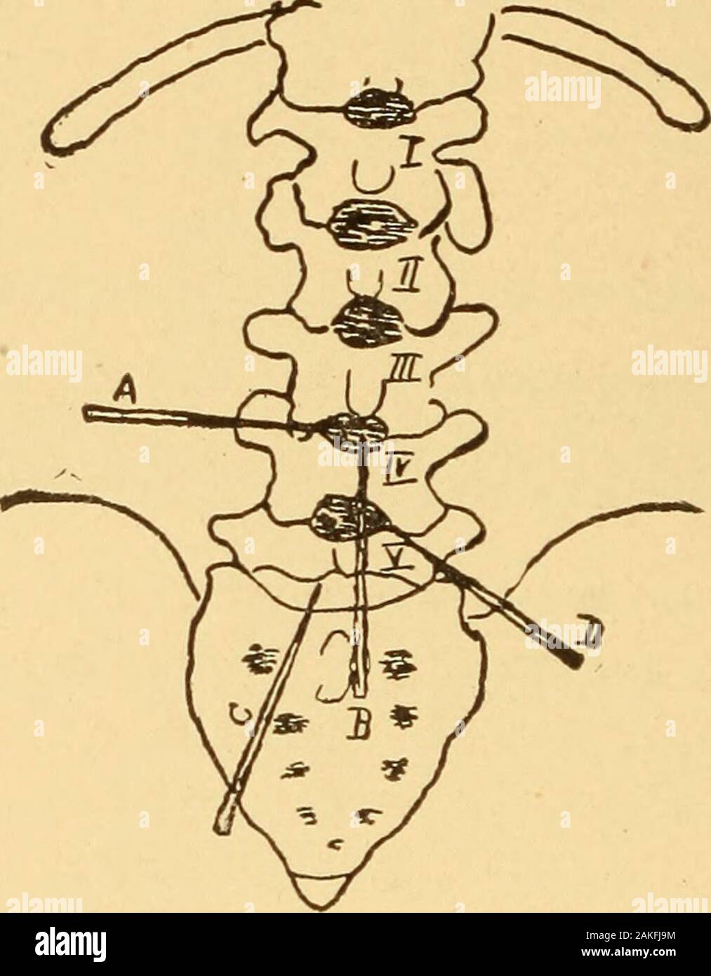 Spinal anaesthesia hi-res stock photography and images - Alamy