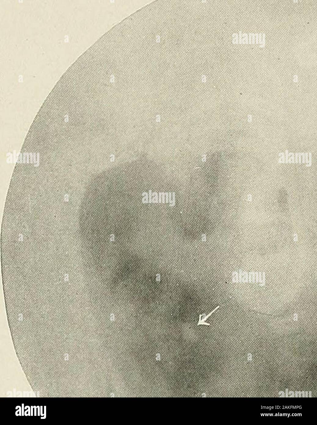 Pyelography (pyelo-ureterography) a study of the normal and pathologic ...