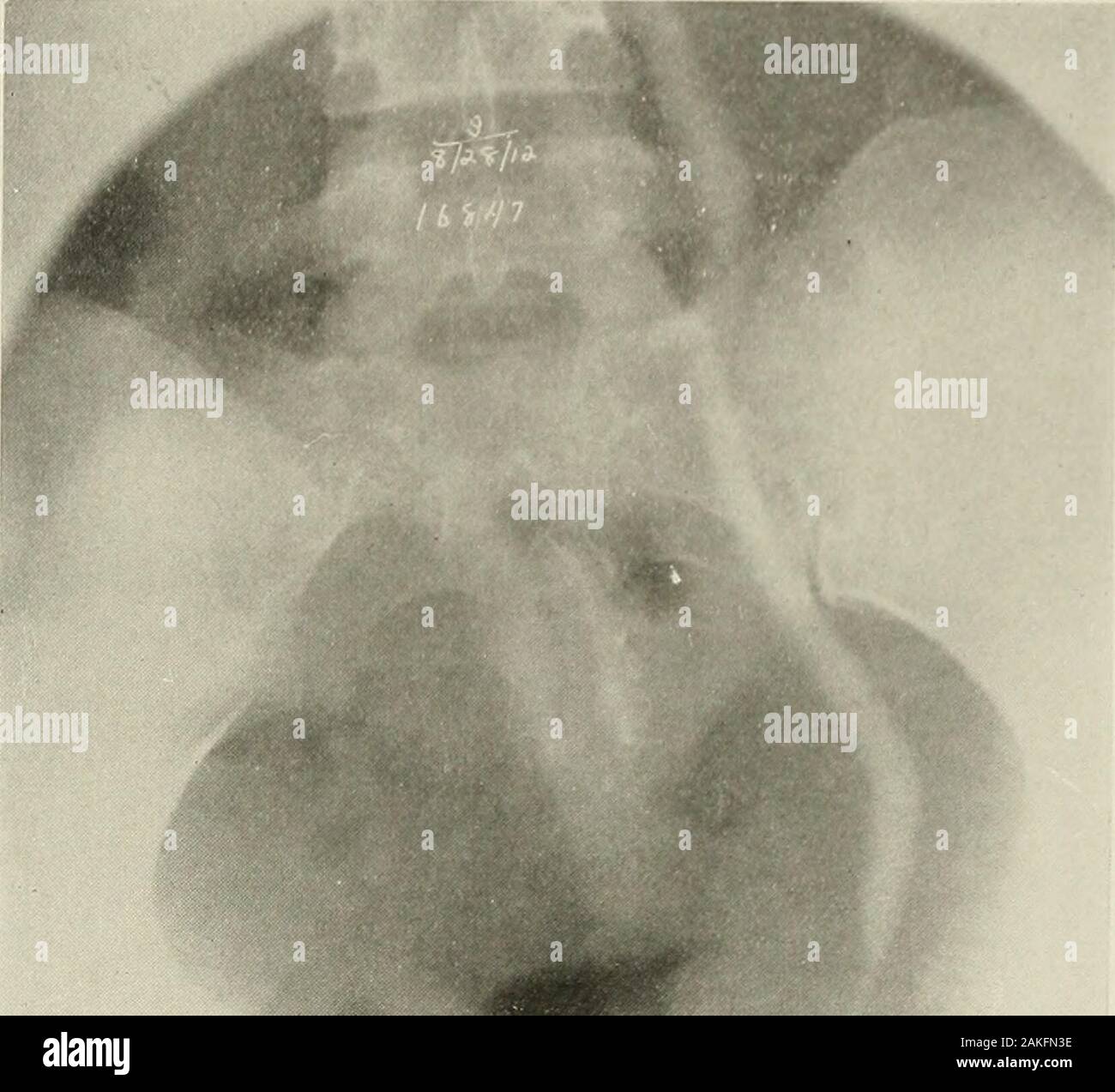 Ureteral hi-res stock photography and images - Alamy