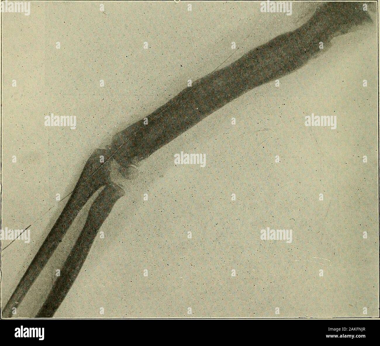 Rheumat hi-res stock photography and images - Alamy