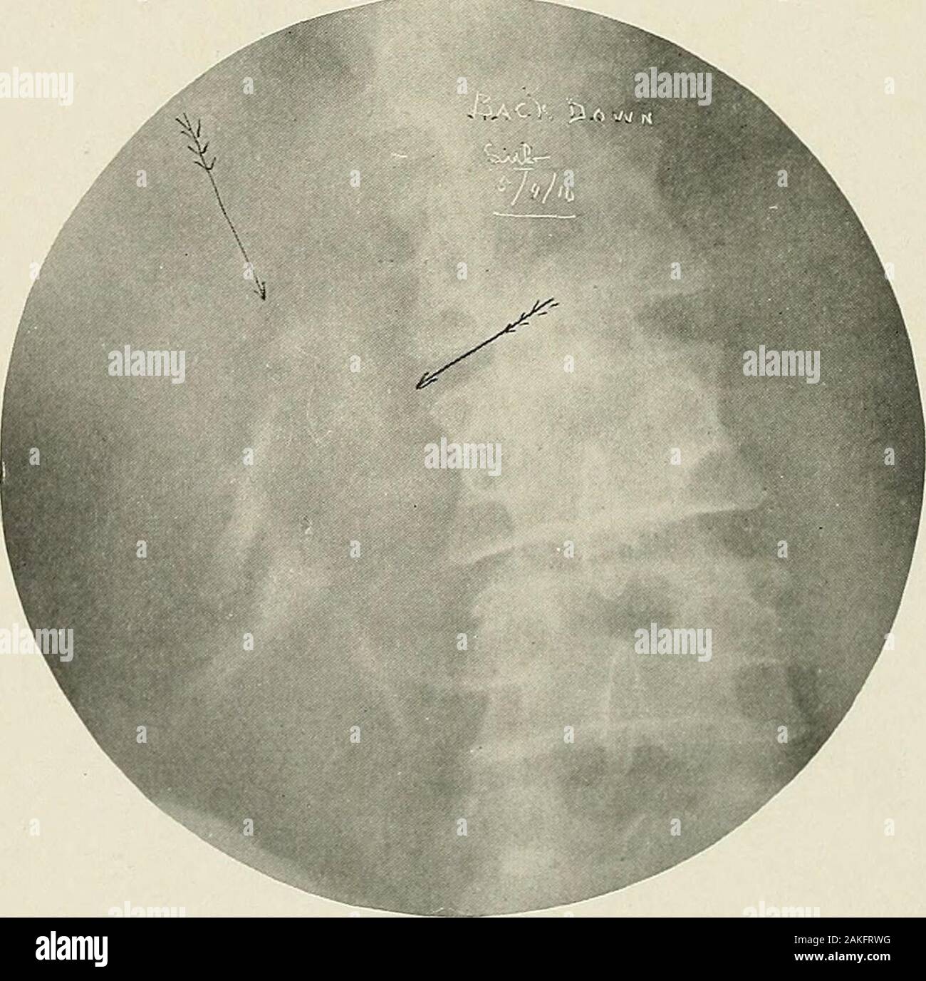 Pyelography (pyelo-ureterography) a study of the normal and pathologic ...