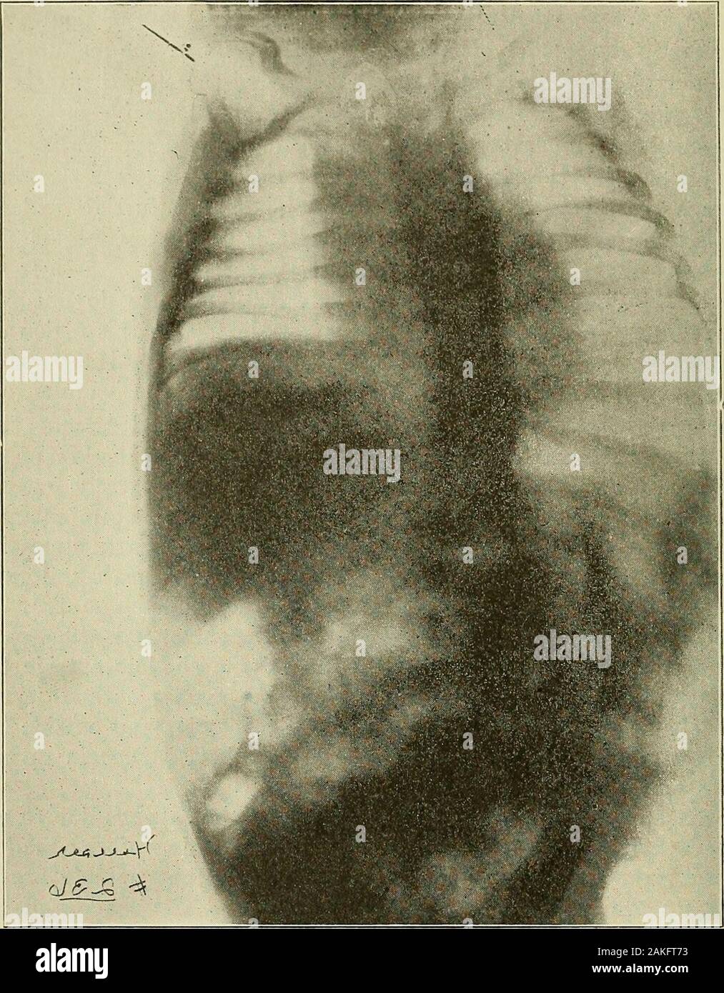 Thymic hi-res stock photography and images - Alamy