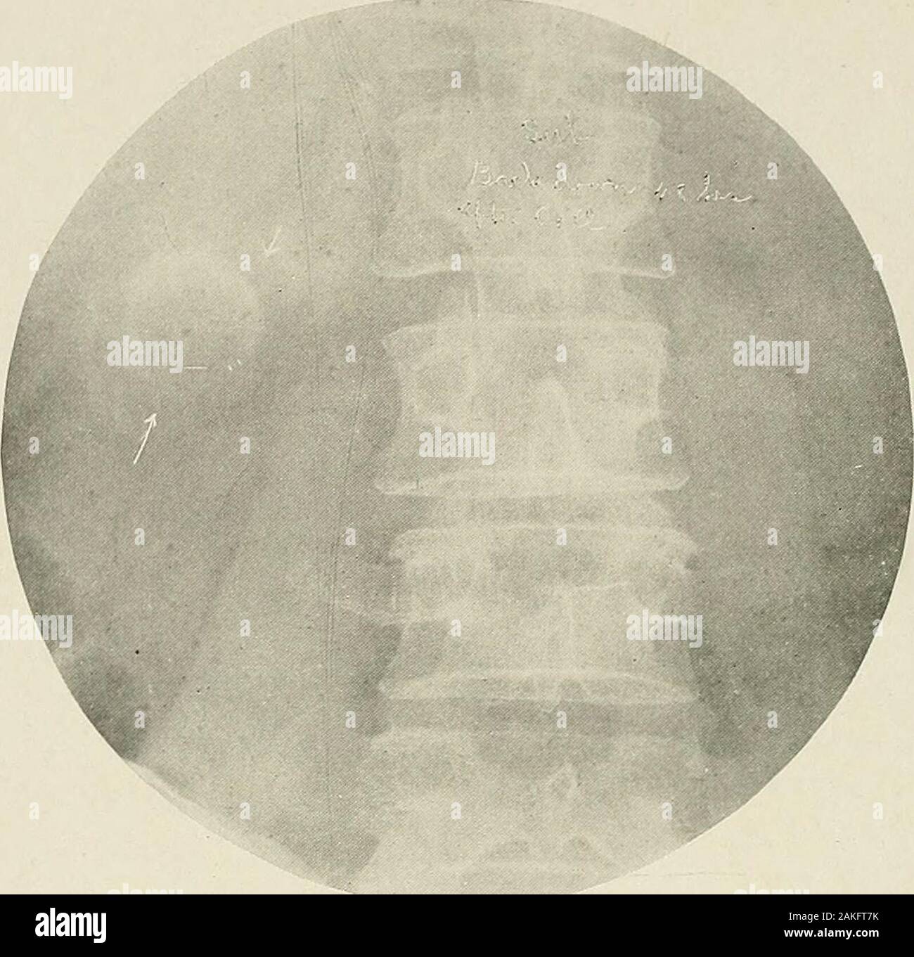 Pyelography (pyelo-ureterography) a study of the normal and pathologic ...