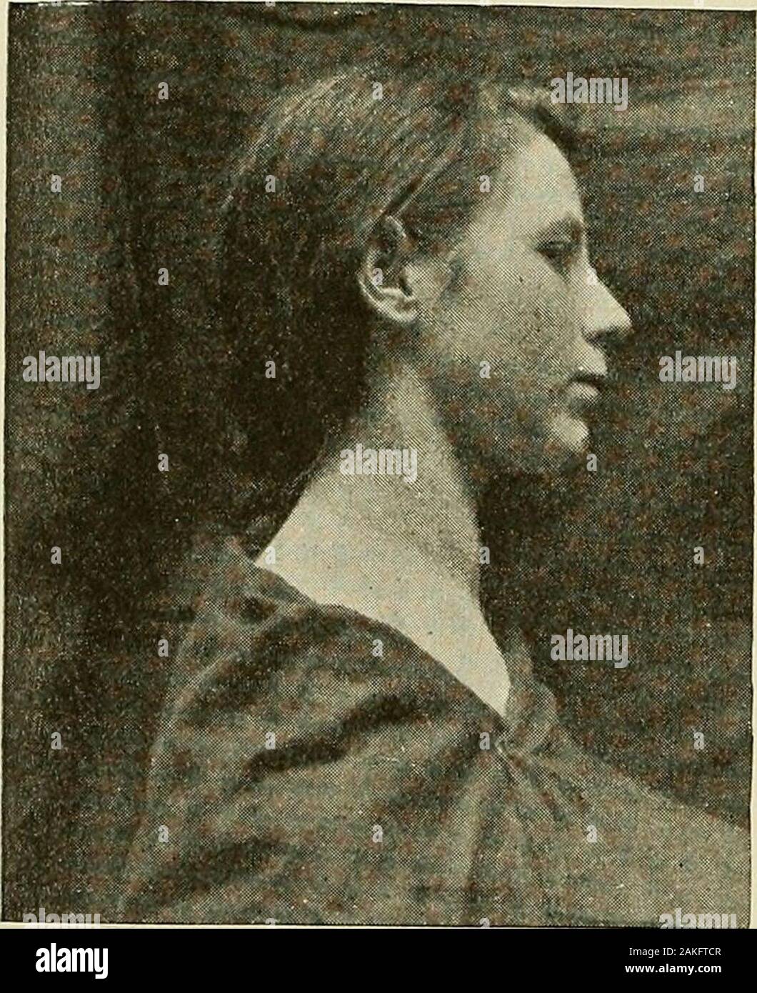 Condition cretinism hi-res stock photography and images - Alamy