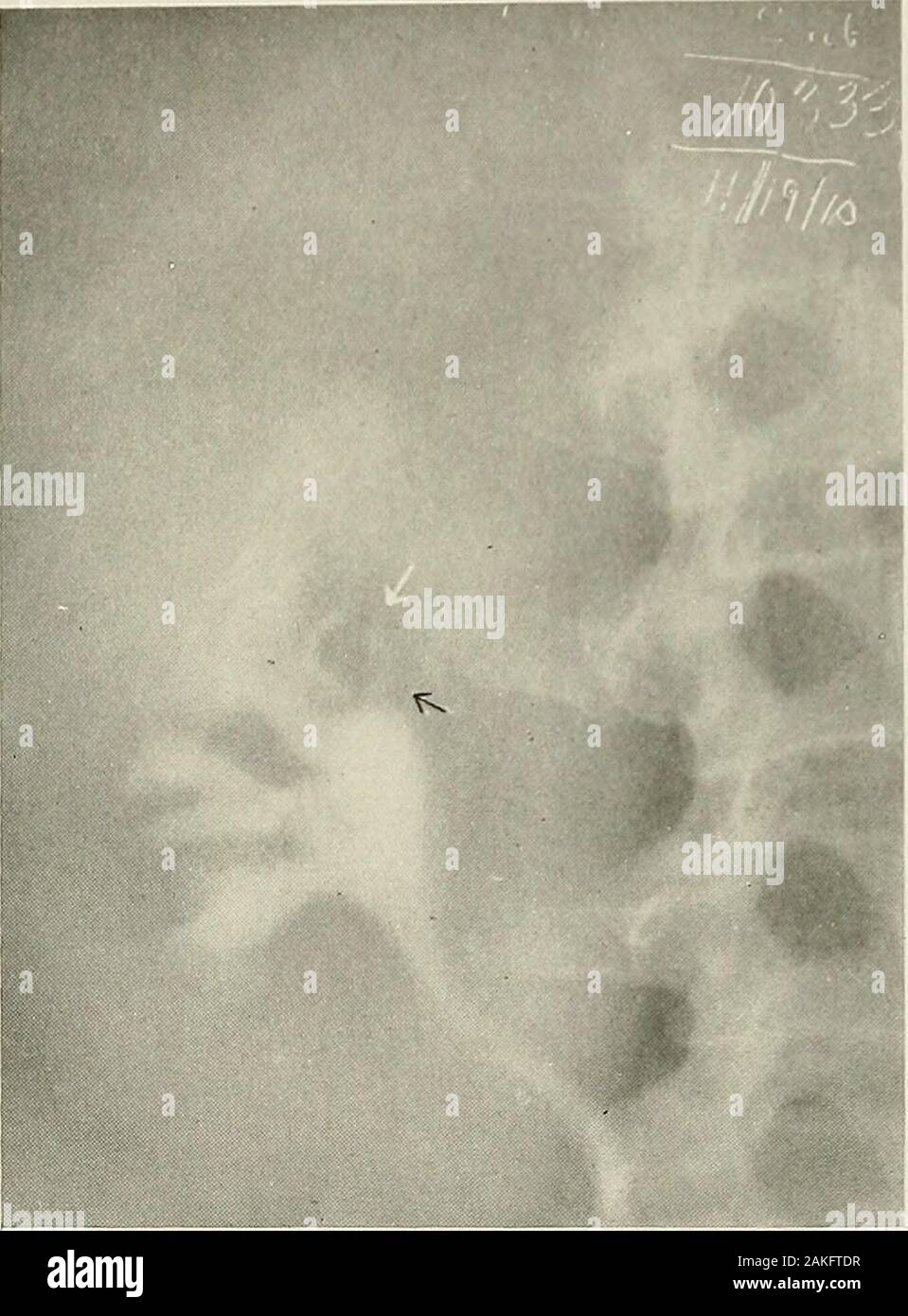 Pyelography (pyelo-ureterography) a study of the normal and pathologic ...