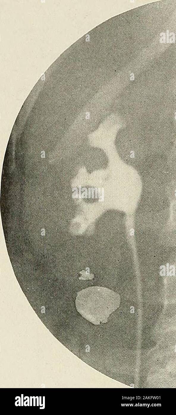Pyelography (pyelo-ureterography) a study of the normal and pathologic ...