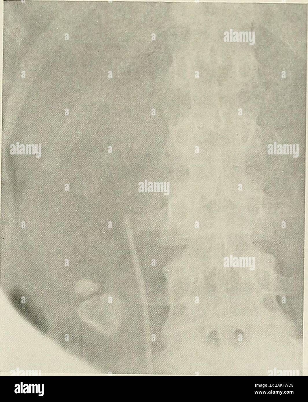 Pyelography (pyelo-ureterography) a study of the normal and pathologic ...