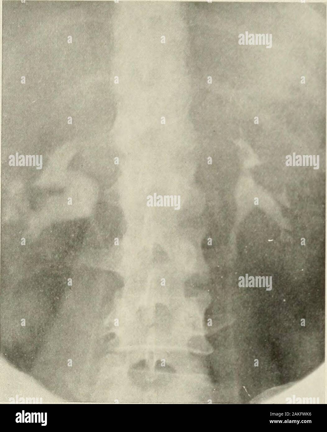 Pyelography (pyelo-ureterography) a study of the normal and pathologic ...