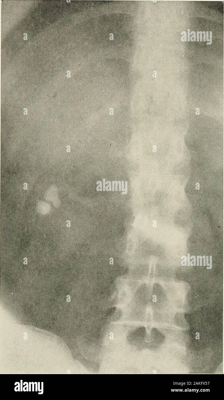 Renal pelvic stone hi-res stock photography and images - Alamy