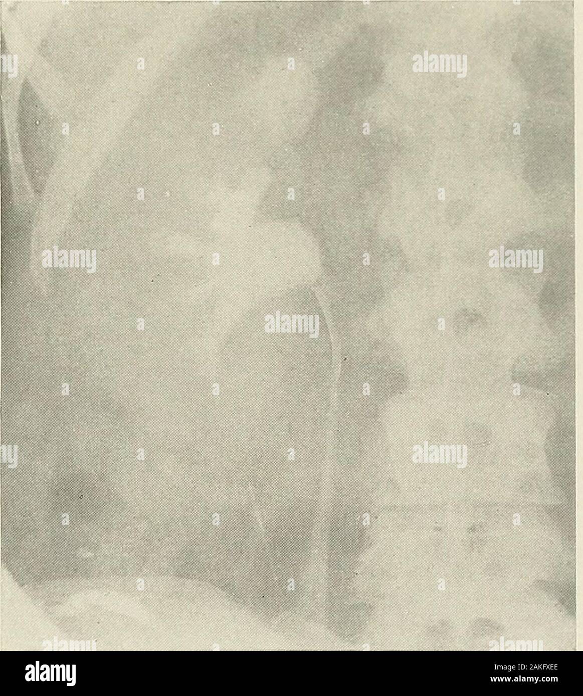 Pyelography (pyelo-ureterography) a study of the normal and pathologic ...