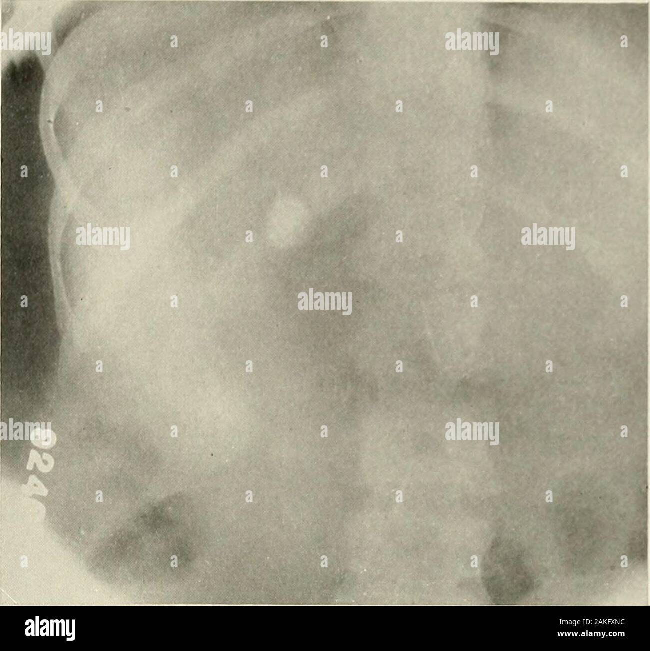 Pyelography (pyelo-ureterography) a study of the normal and pathologic ...