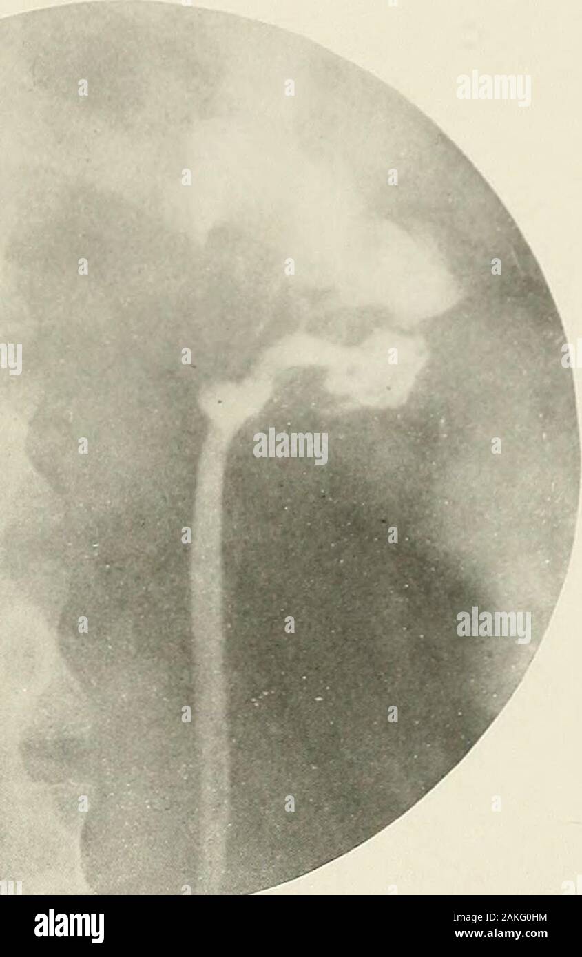 Pyelography (pyelo-ureterography) a study of the normal and pathologic ...