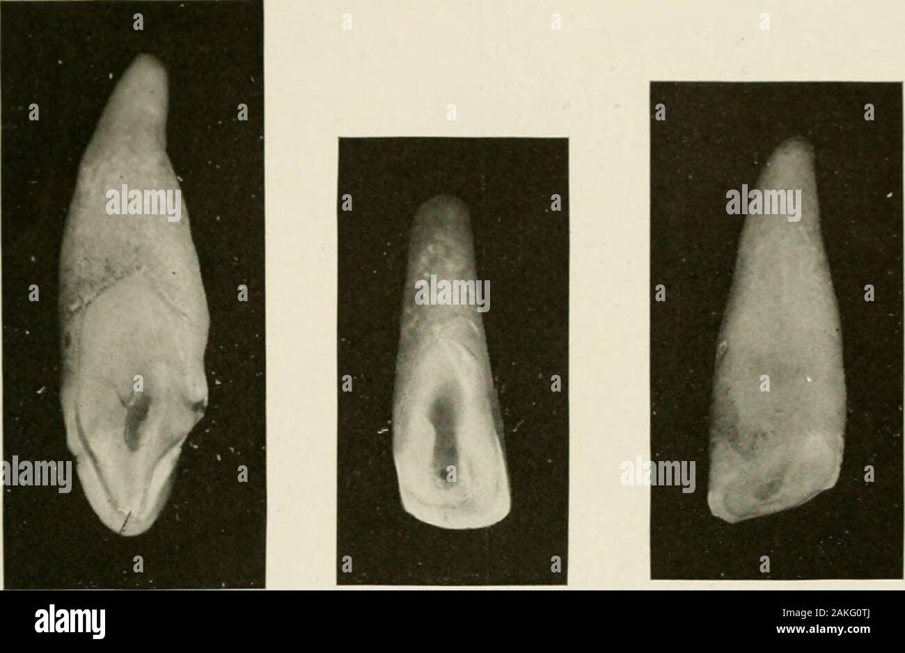 Primary secondary teeth hi-res stock photography and images - Alamy