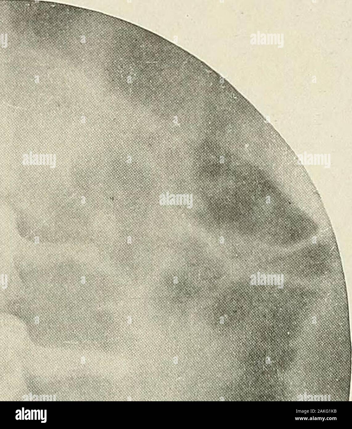 Pyelography (pyelo-ureterography) a study of the normal and pathologic ...