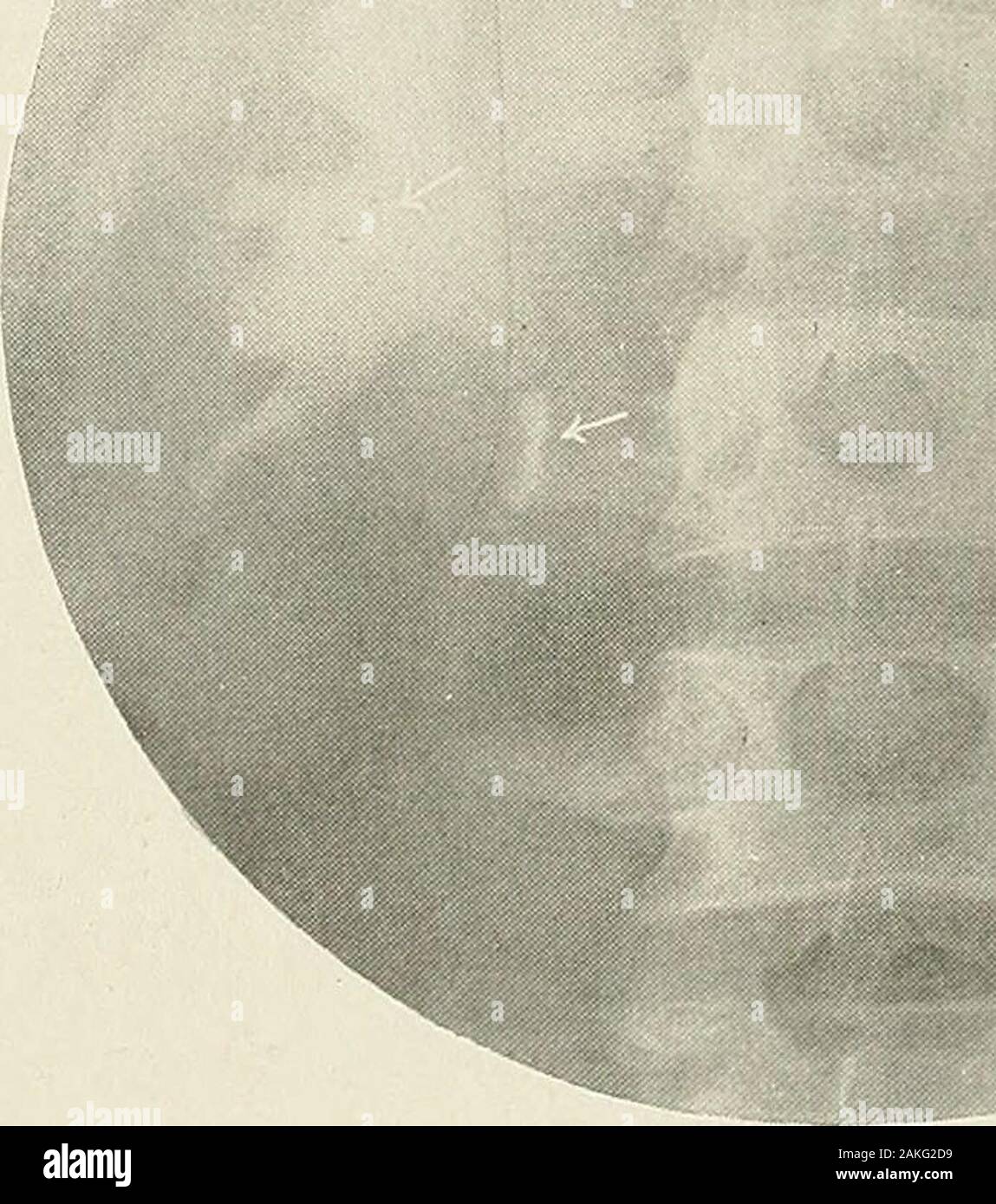 Pyelography (pyelo-ureterography) a study of the normal and pathologic ...