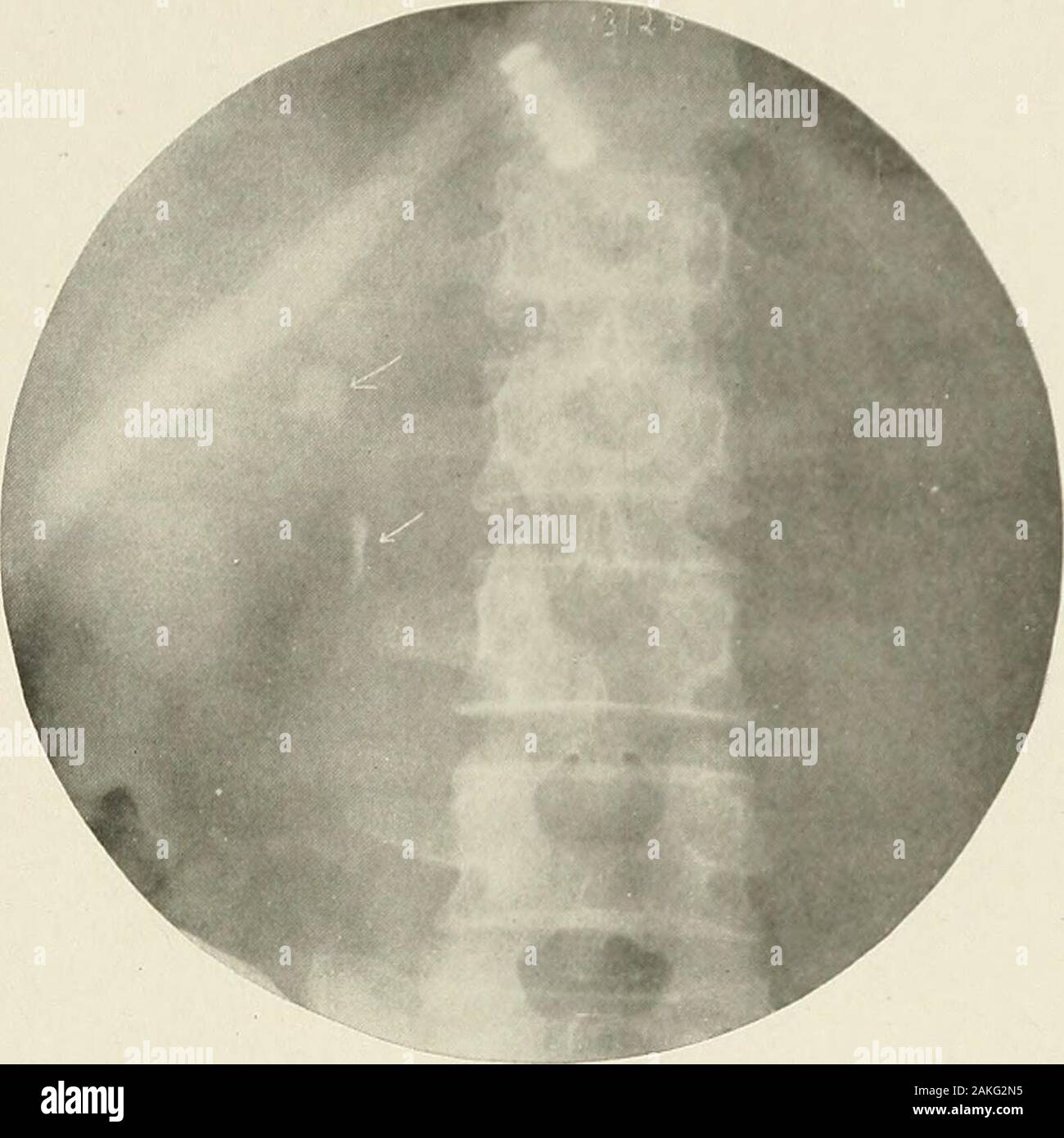 Pyelography (pyelo-ureterography) a study of the normal and pathologic ...