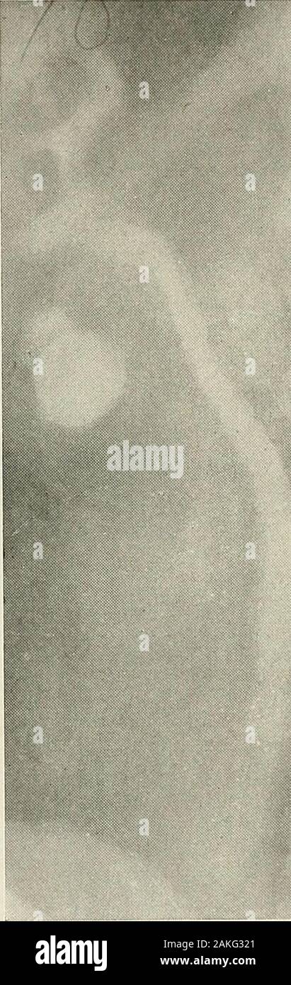 Pyelography (pyelo-ureterography) a study of the normal and pathologic ...