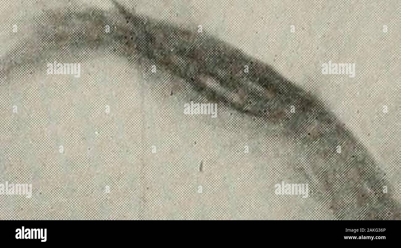 Adenoid hi-res stock photography and images - Alamy