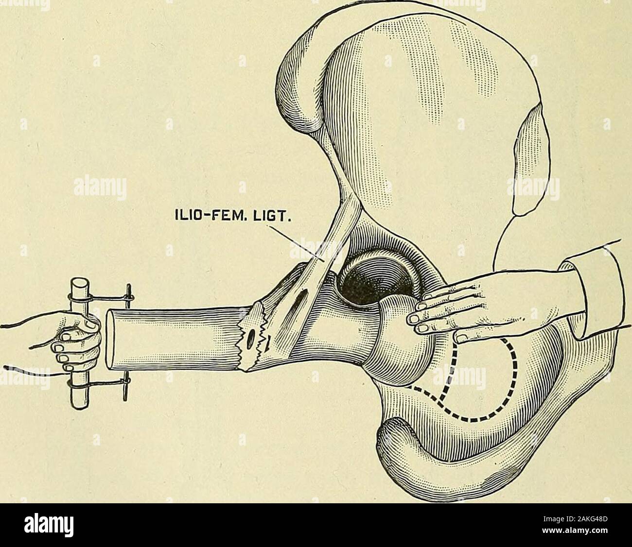 Hip fracture rotation hi-res stock photography and images - Alamy