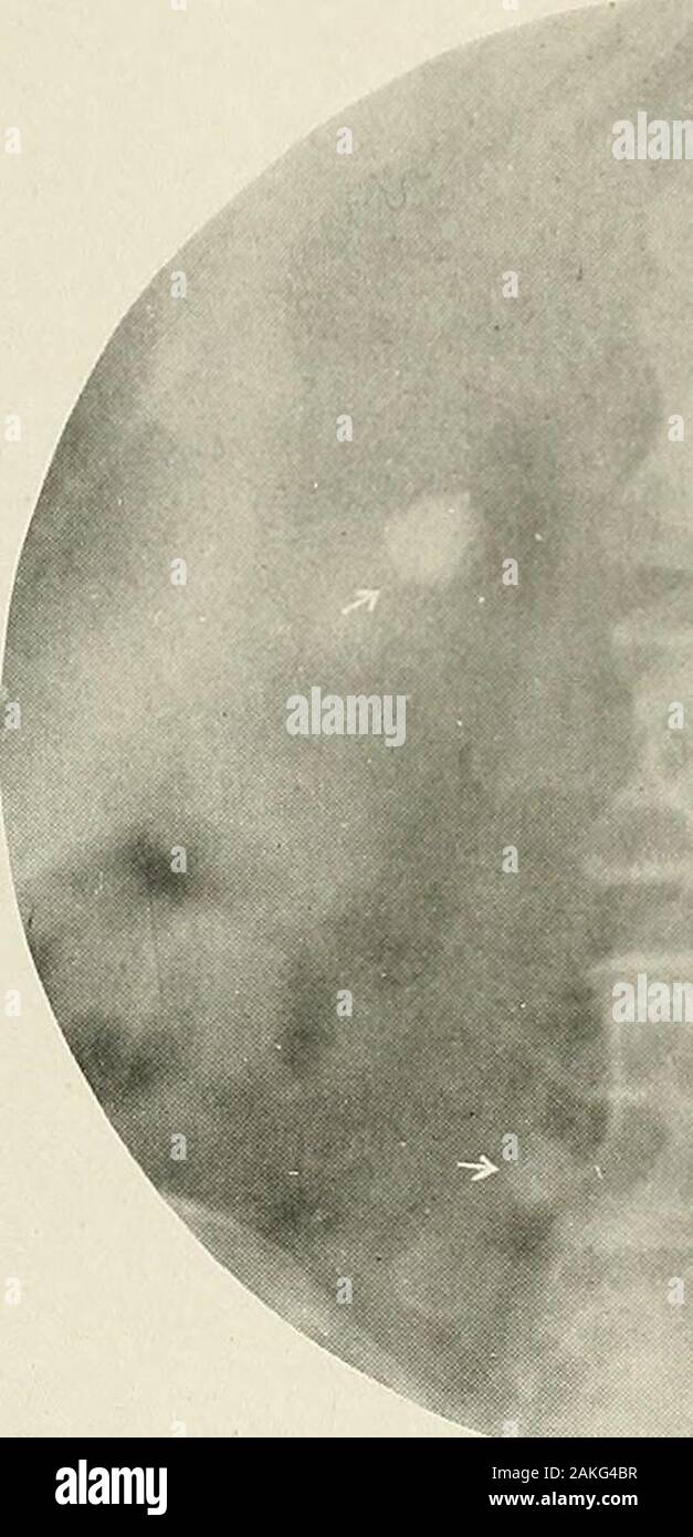 Pyelography (pyelo-ureterography) a study of the normal and pathologic ...