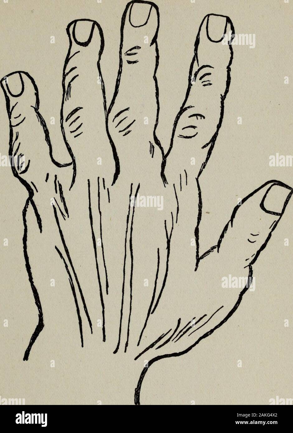 Spreading plasters hi-res stock photography and images - Alamy