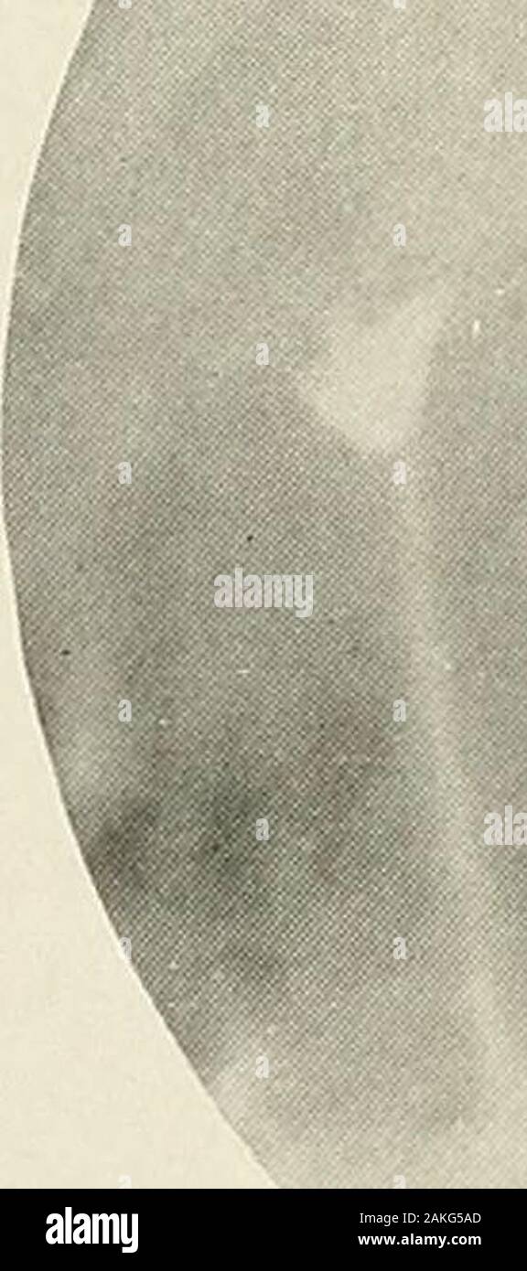 Pyelography (pyelo-ureterography) a study of the normal and pathologic ...