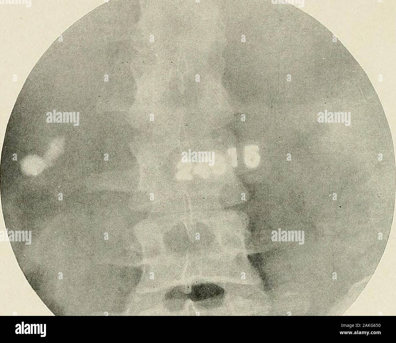 Renal calyces hi-res stock photography and images - Alamy