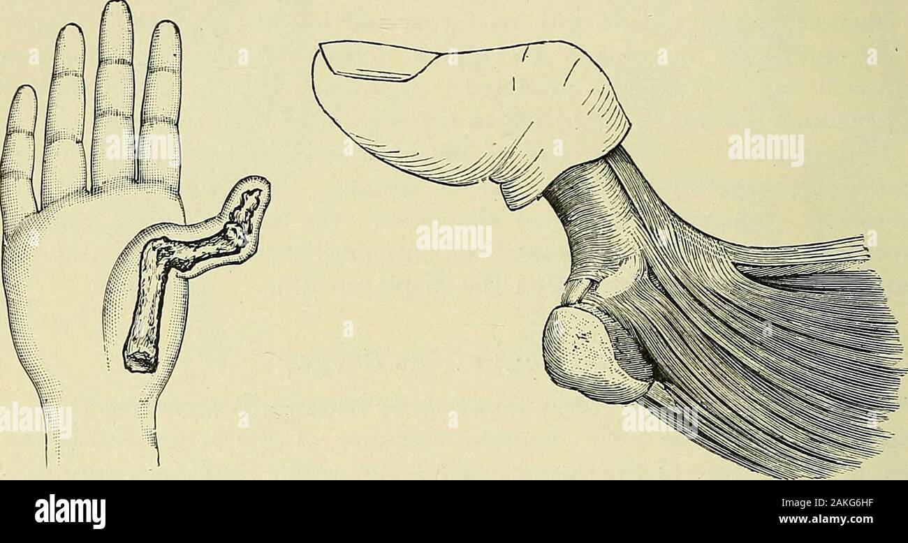 Joint dislocations hi-res stock photography and images - Alamy