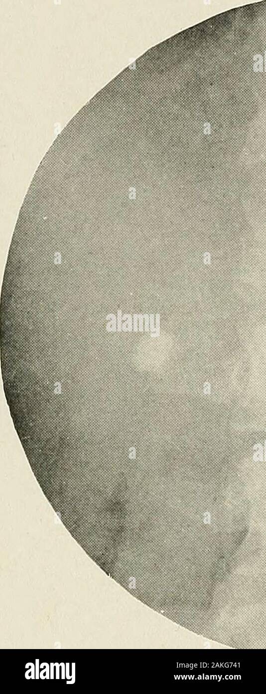 Pyelography (pyelo-ureterography) a study of the normal and pathologic ...