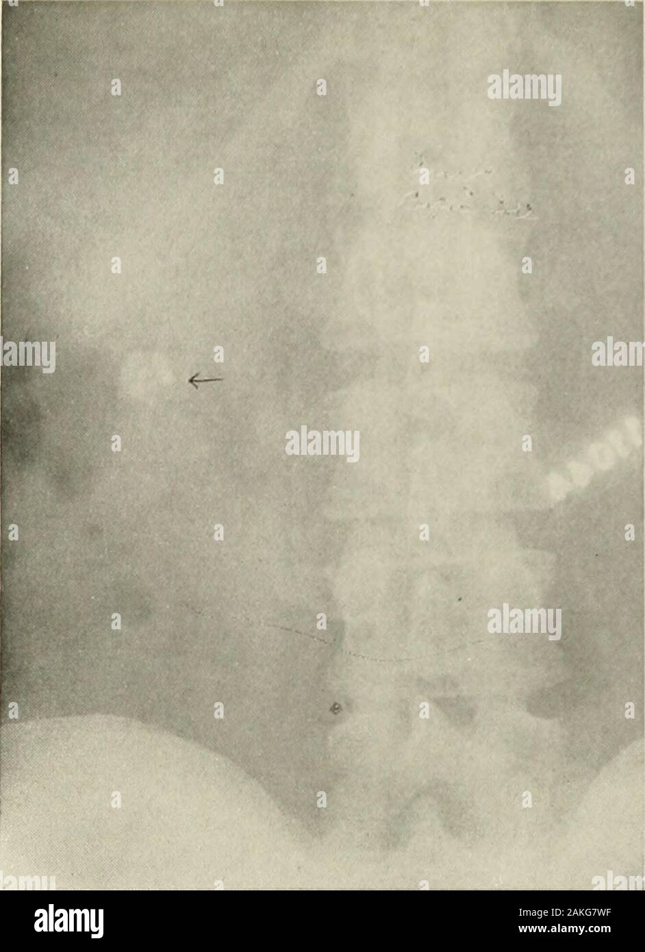 Pyelography (pyelo-ureterography) a study of the normal and pathologic ...