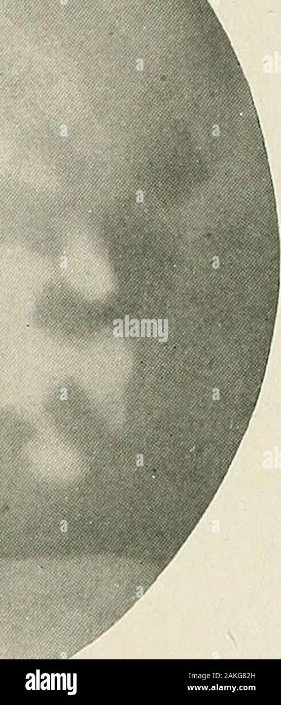 Pyelography (pyelo-ureterography) a study of the normal and pathologic ...