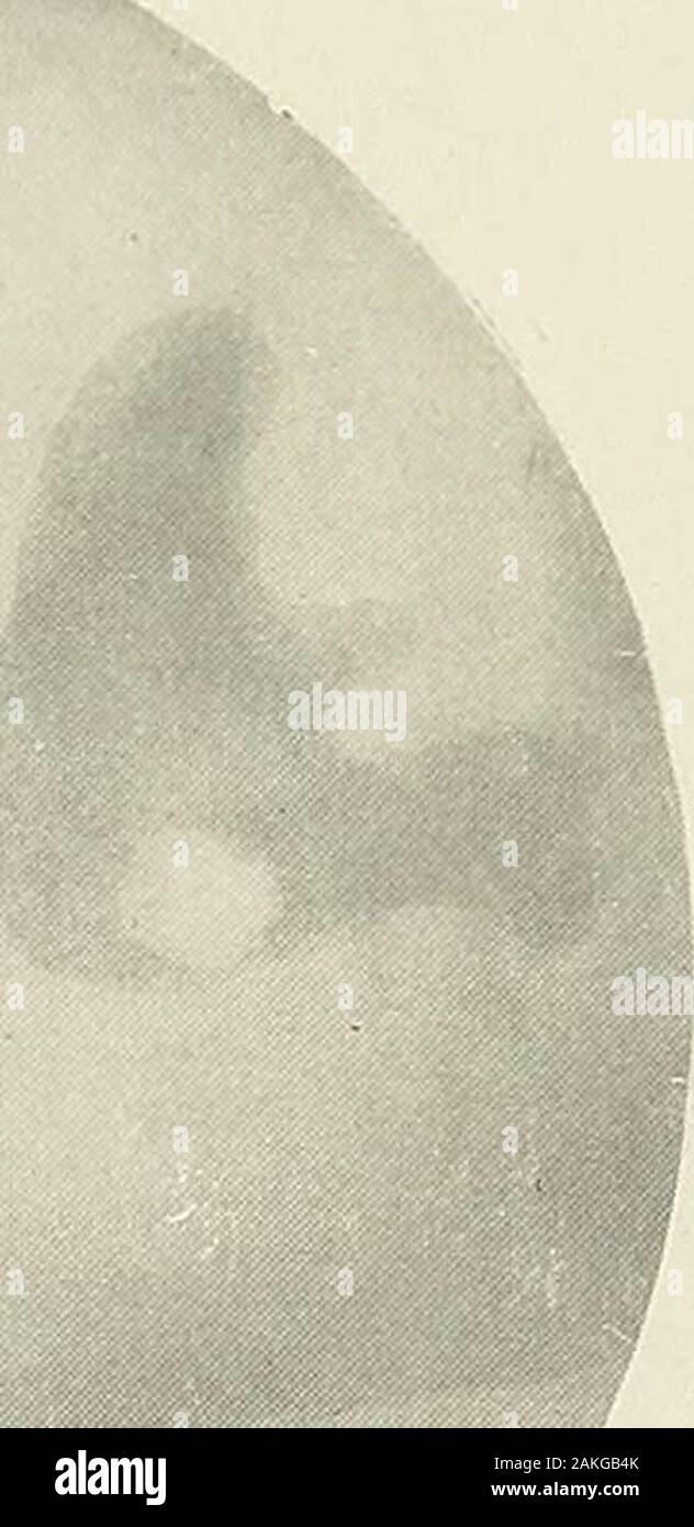 Pyelography (pyelo-ureterography) a study of the normal and pathologic ...