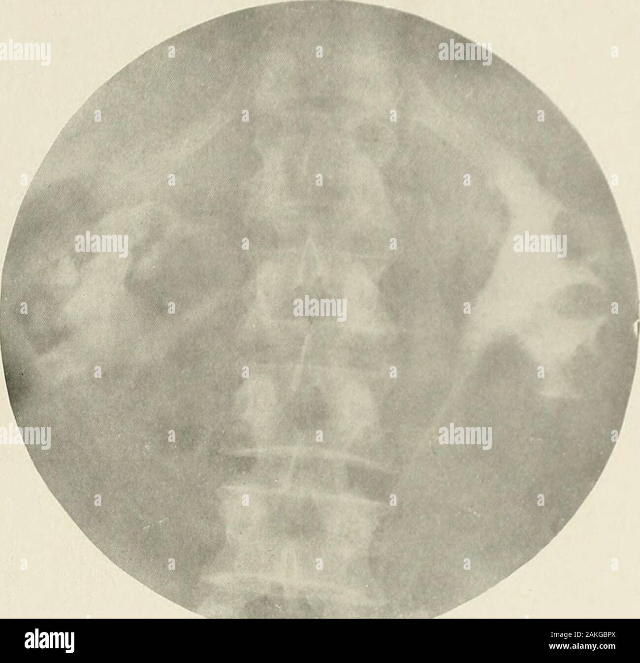 Pyelography (pyelo-ureterography) a study of the normal and pathologic ...