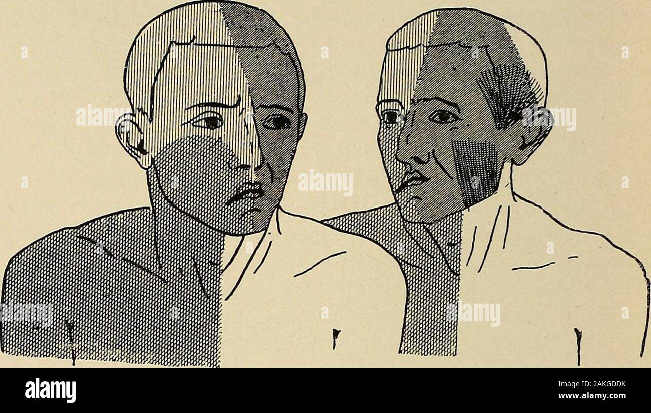 Diseases of the nervous system : a text-book of neurology and ...