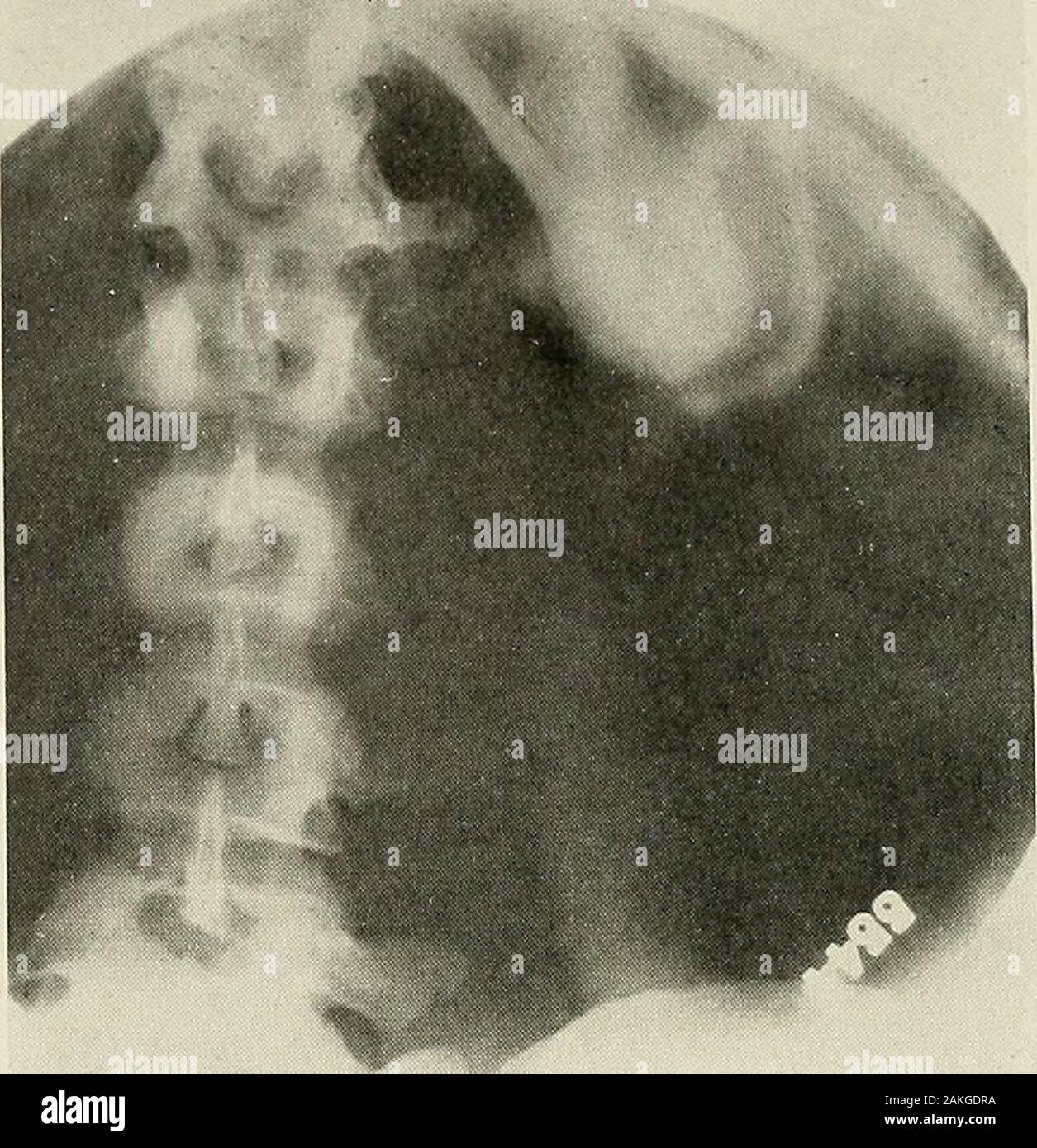 Pyelography (pyelo-ureterography) a study of the normal and pathologic ...