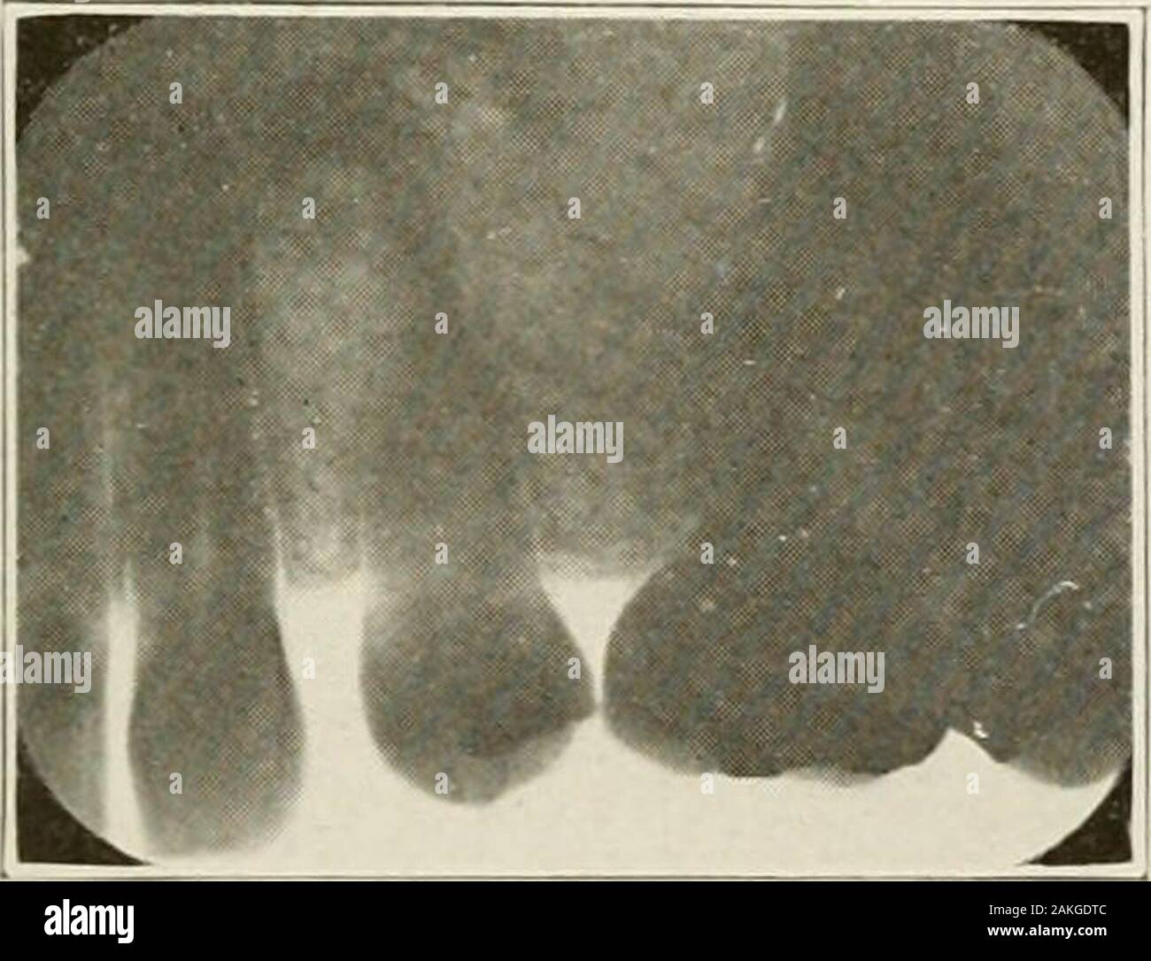 Pyorrhea hi-res stock photography and images - Alamy