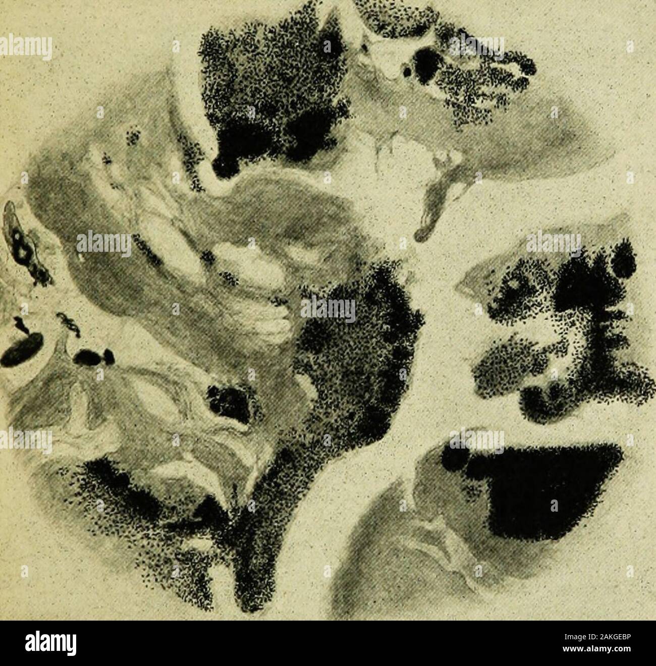 Rheumatic aortic valve hi-res stock photography and images - Alamy