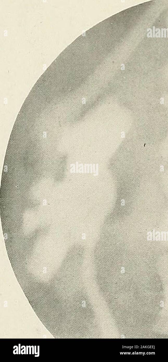 Pyelography (pyelo-ureterography) a study of the normal and pathologic ...