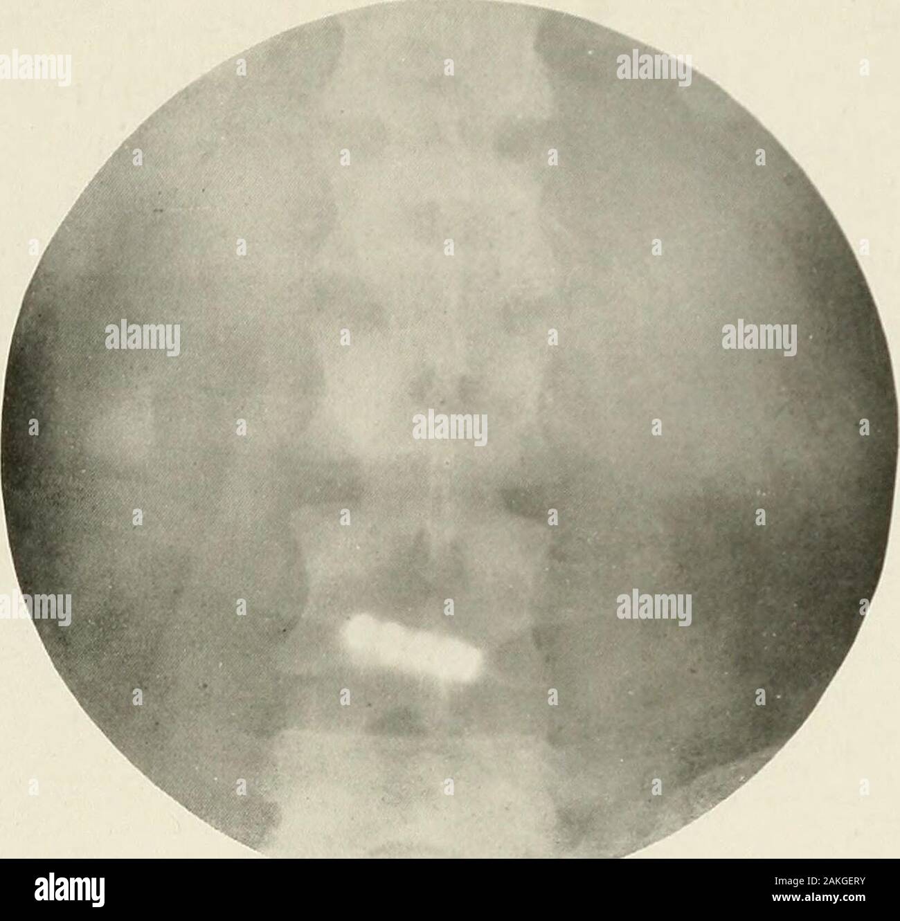 Pyelography (pyelo-ureterography) a study of the normal and pathologic ...