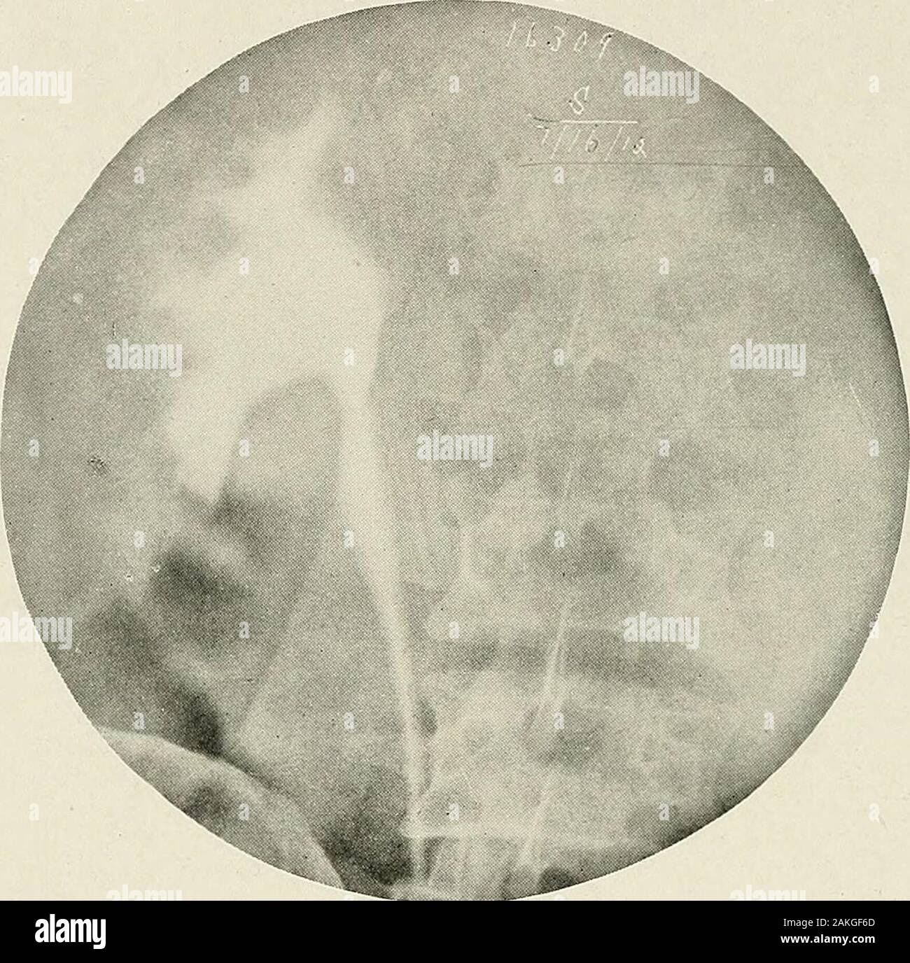 Pyelography (pyelo-ureterography) a study of the normal and pathologic ...