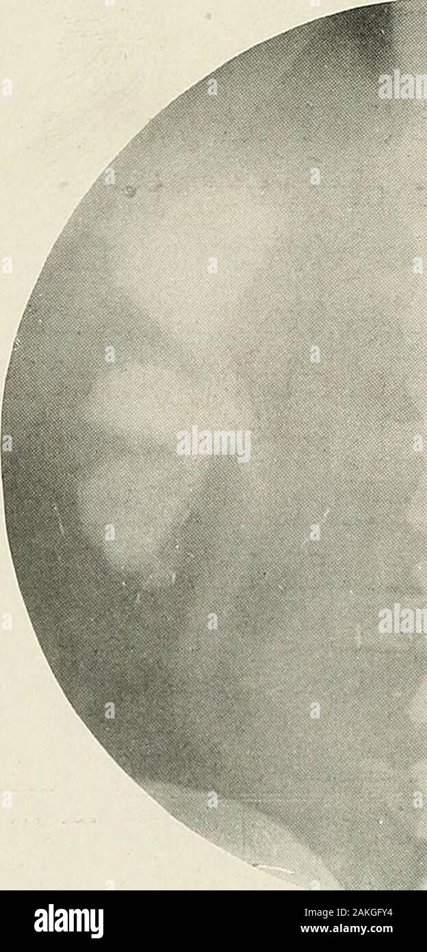 Pyelography (pyelo-ureterography) a study of the normal and pathologic ...
