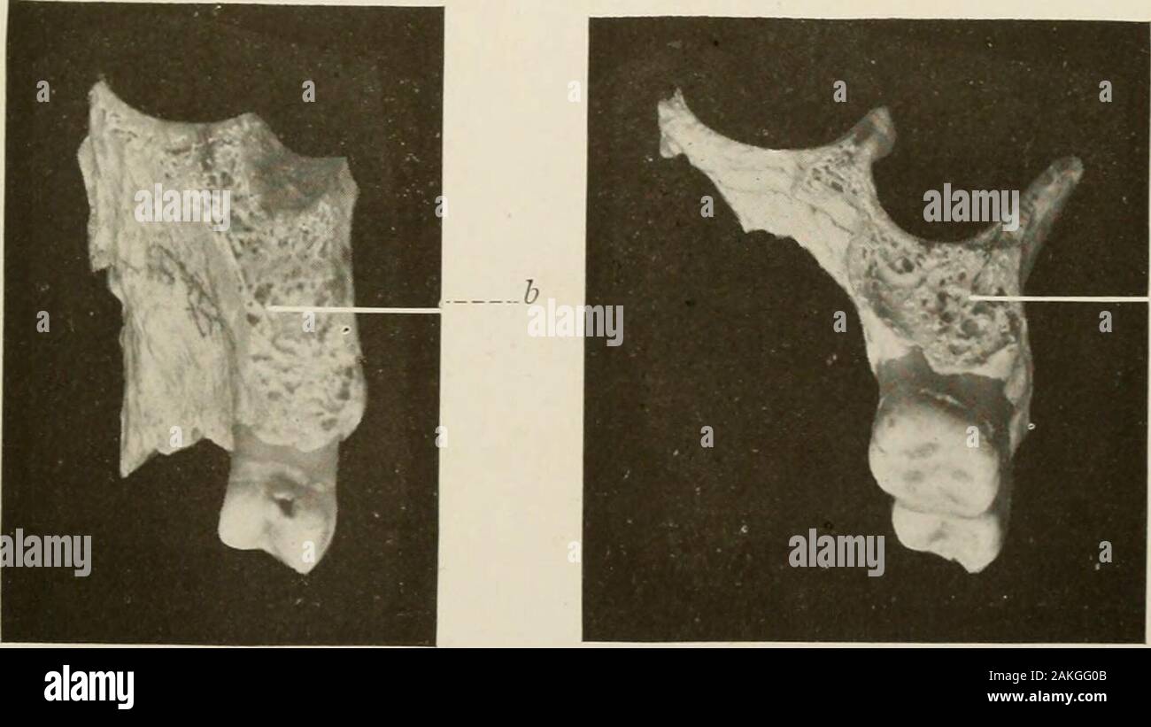 Alveolar septum hi-res stock photography and images - Alamy