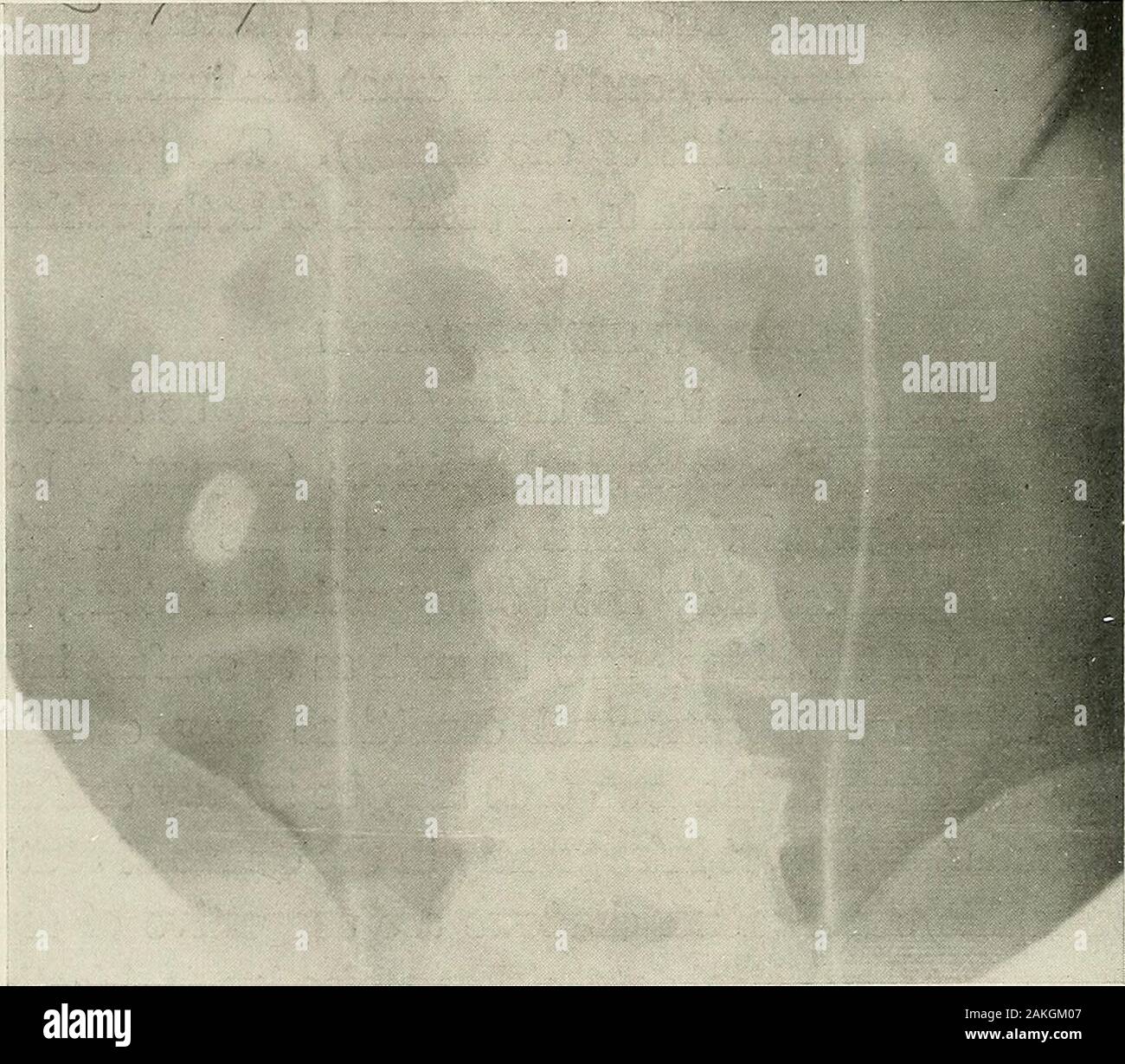 Pyelography (pyelo-ureterography) a study of the normal and pathologic ...