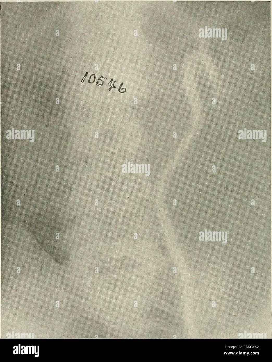Pyelography (pyelo-ureterography) a study of the normal and pathologic ...