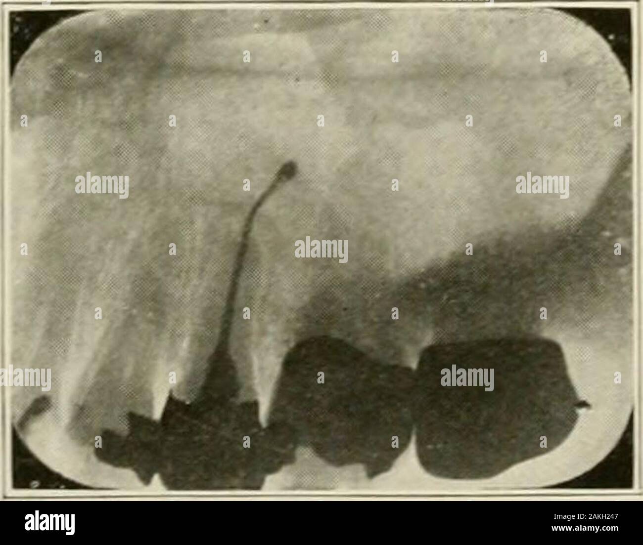 Dental cyst hi-res stock photography and images - Alamy