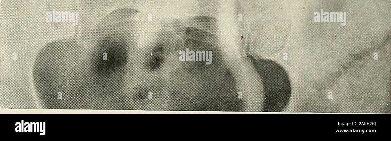 Pyelitis hi-res stock photography and images - Alamy