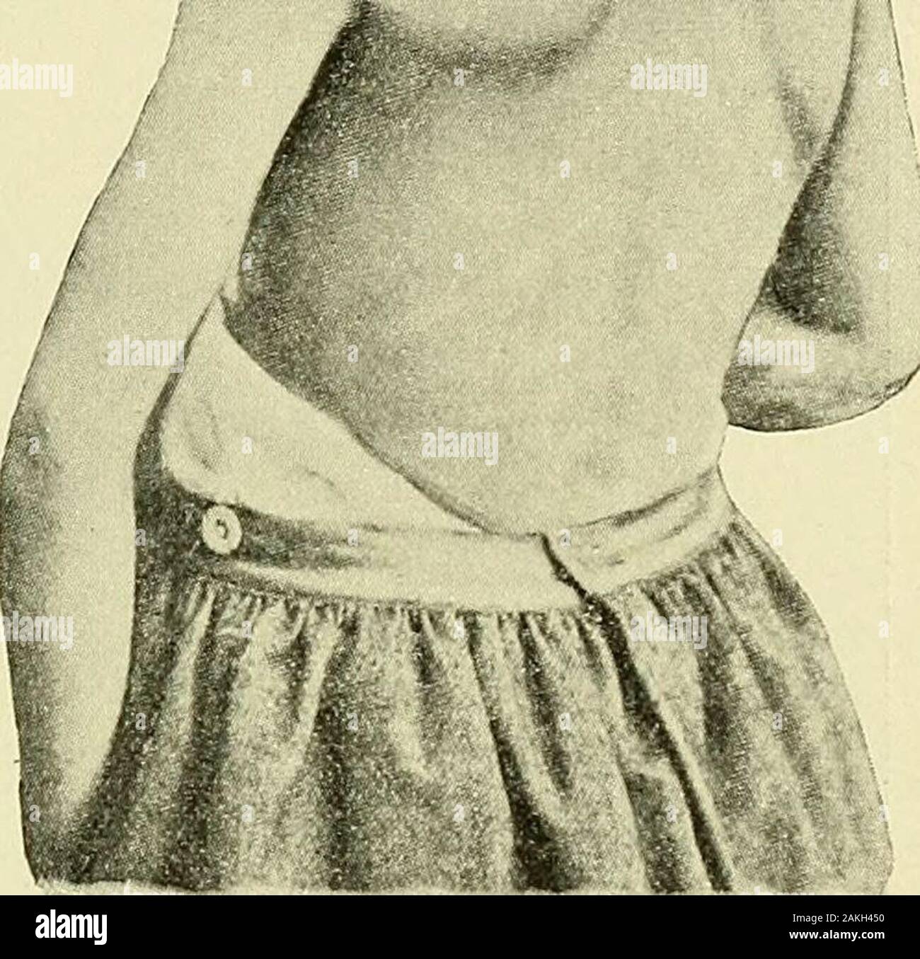 Congenital dislocation of the hip hi-res stock photography and images ...