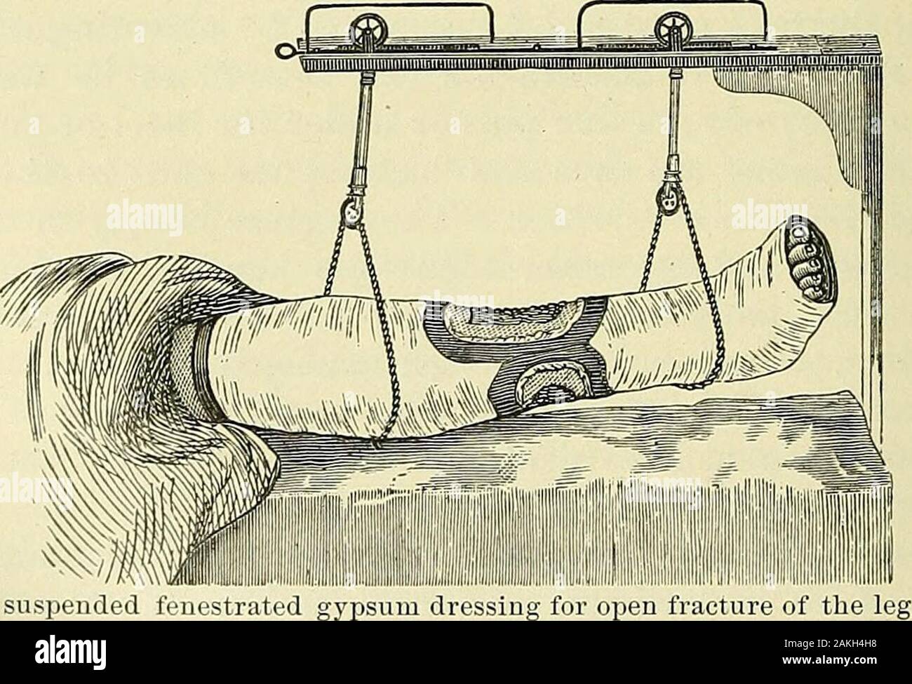 Plaster splint gypsum hi-res stock photography and images - Alamy