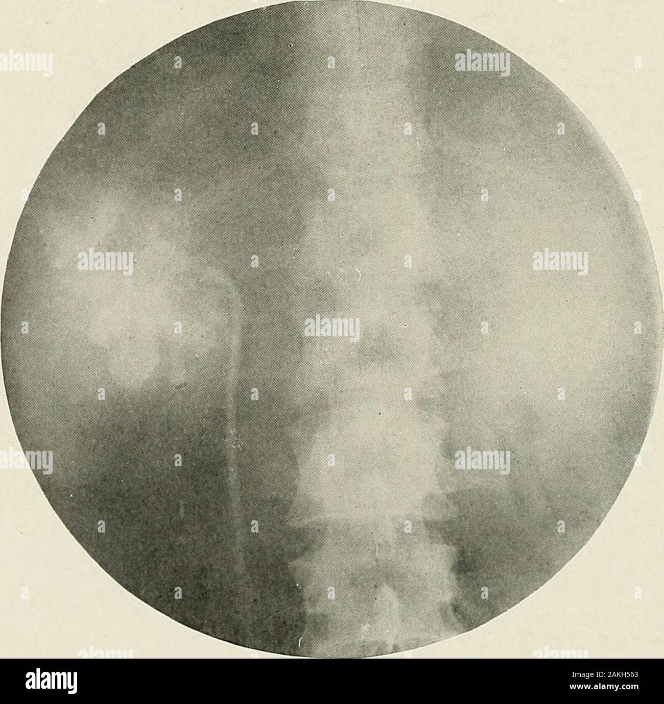 Pyelography (pyelo-ureterography) a study of the normal and pathologic ...